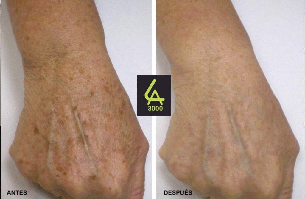 Eliminar manchas y pecas con láser en Toledo